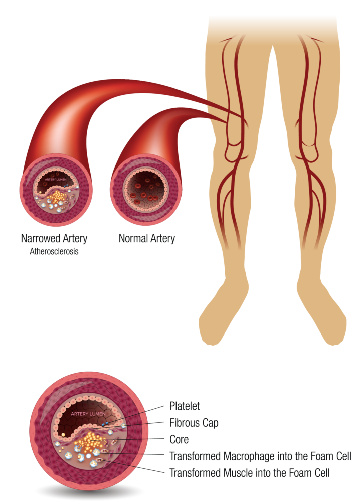 Efemoral Medical | Peripheral Vascular Disease